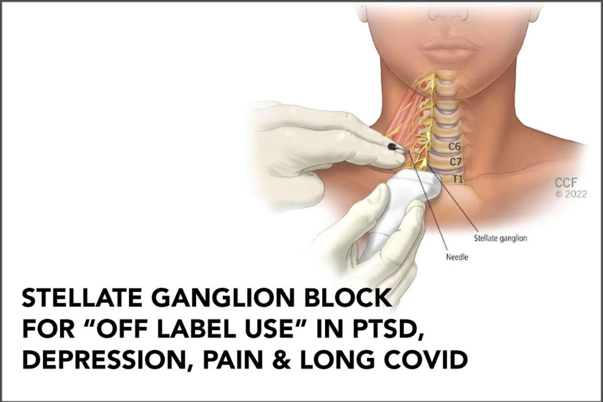 Stellate Ganglion